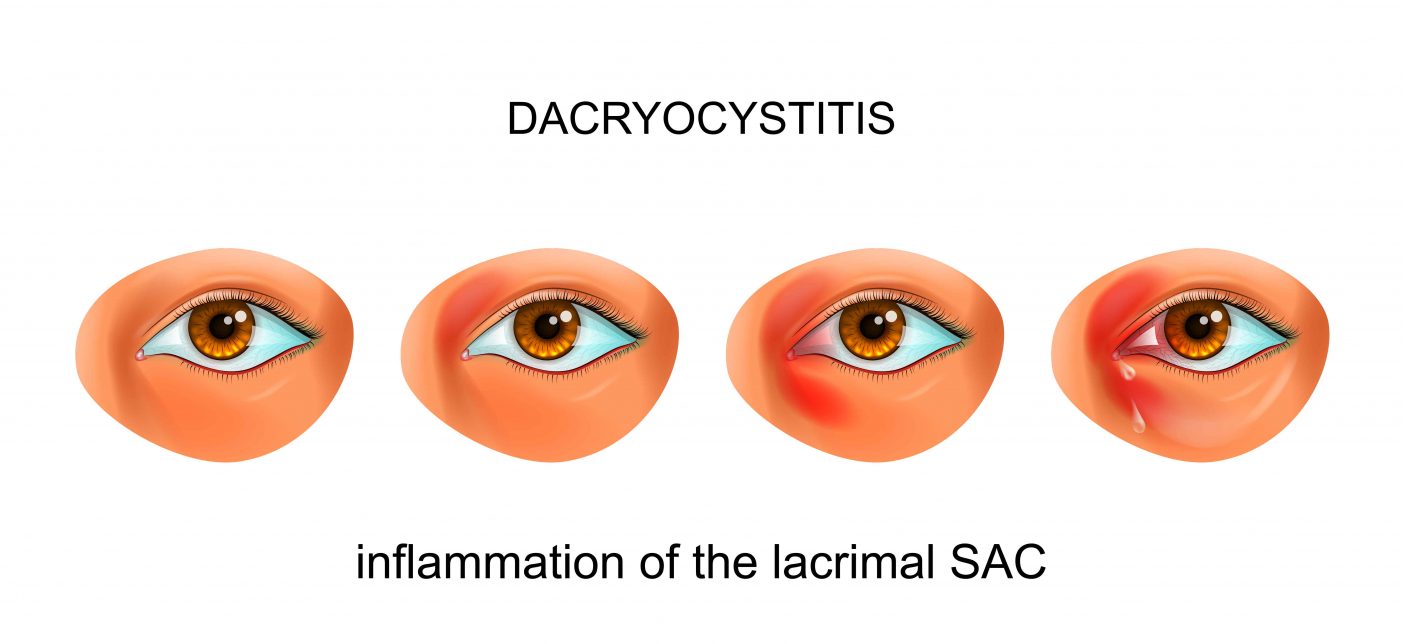 Acute Dacryocystitis